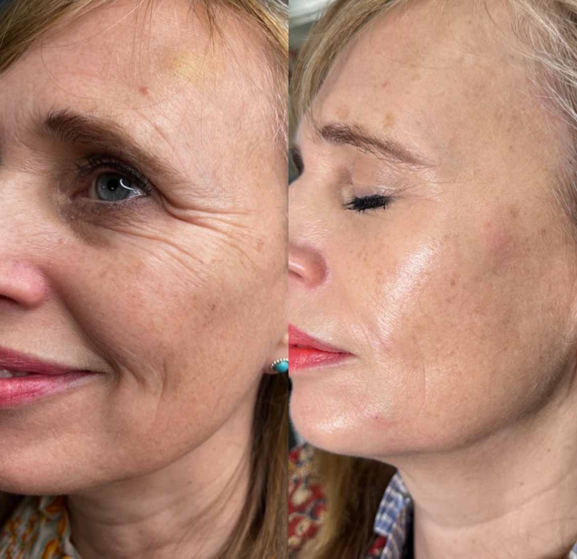 Skin Booster Injectables – Exult Cosmetics