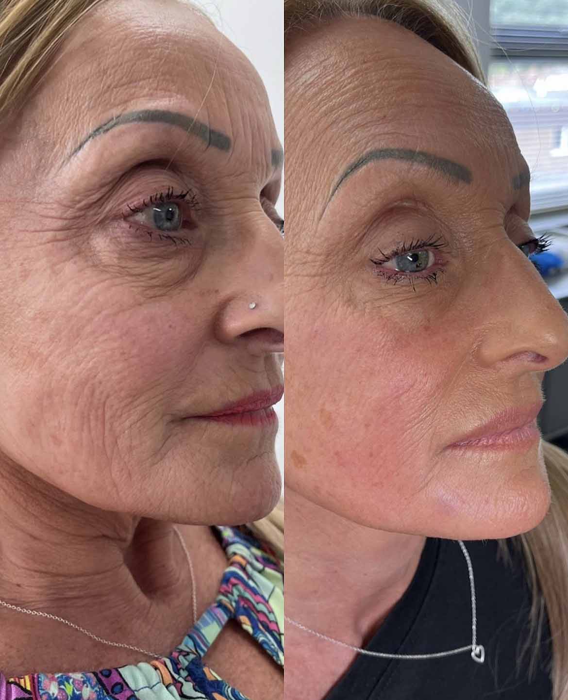Skin Booster Injectables – Exult Cosmetics